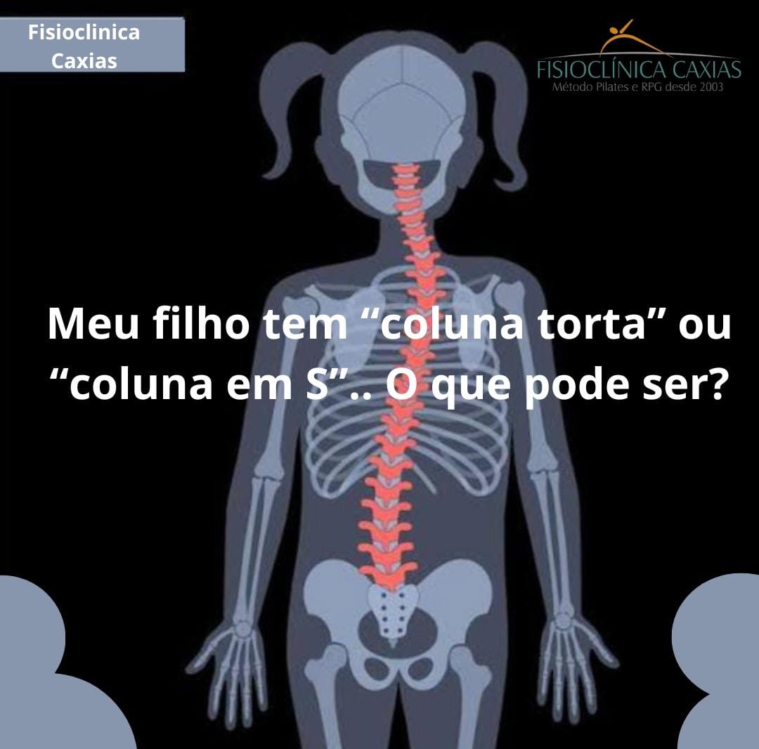 "Coluna torta" o que eu posso fazer para corrigir? - Fisioclínica Caxias